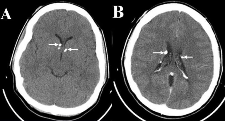 Tuberous sclerosis confirmed on neuroimaging: A case report and ...