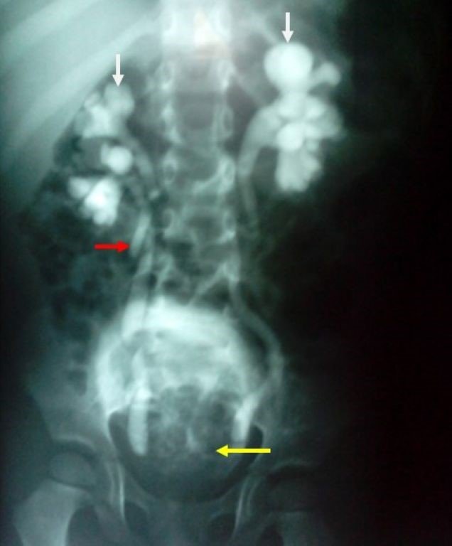 BOTRYOIDES SARCOMA OF THE URINARY BLADDER: CASE REPORT - Yenagoa ...